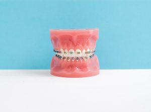What Do I Do If My Teeth Shift After Braces? « Smile Team Orthodontics ...