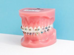 Braces Colours: How to Choose the Right One for Your Smile « Smile Team ...