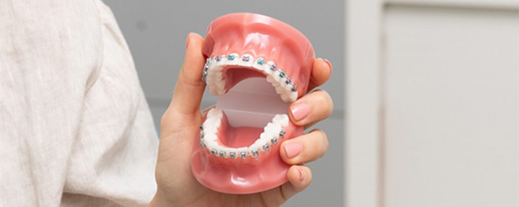 How to Straighten Teeth Without Braces « Smile Team Orthodontics | Blog