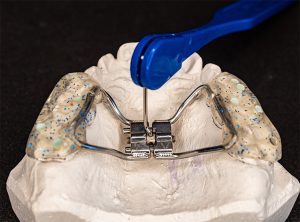 Palate Expanders: How They Work, Who Needs Them, and What to Expect ...